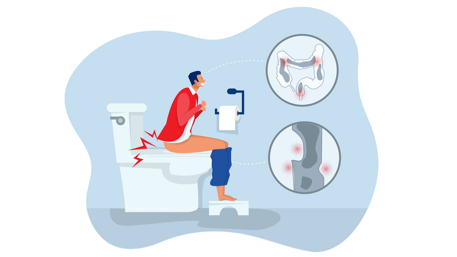 Tout savoir sur les hémorroïdes (inflammation des veines hémorroïdaires)