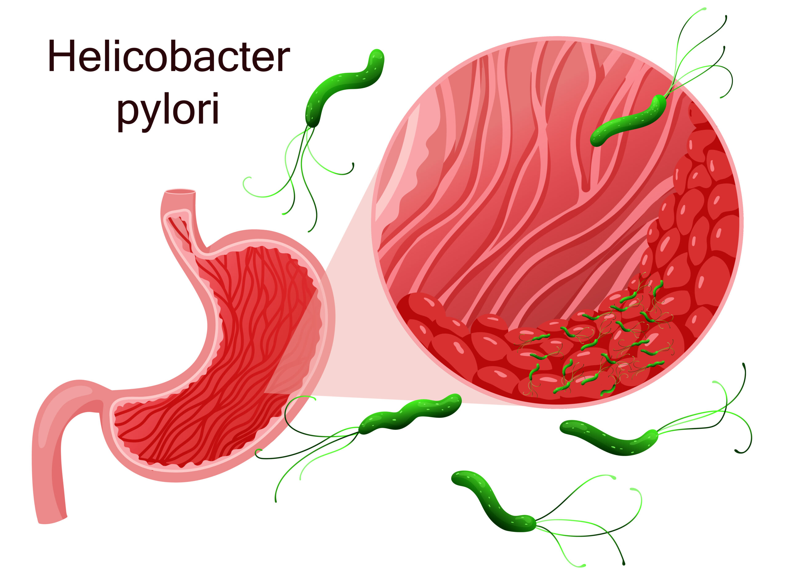 Helicobacter pylori in stomach epithelial cells under magnificat - Welliecare
