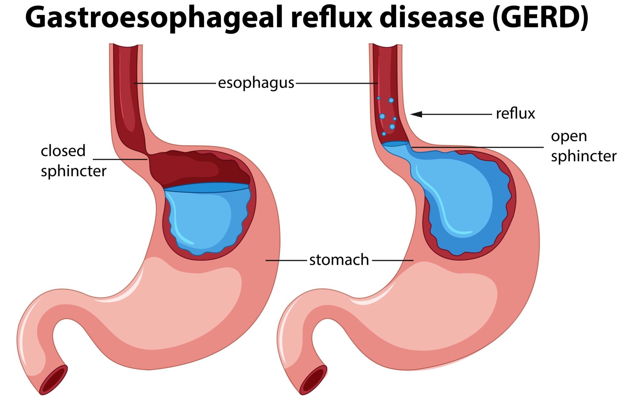 L'œsophage : rôle, complications et comment en prendre soin