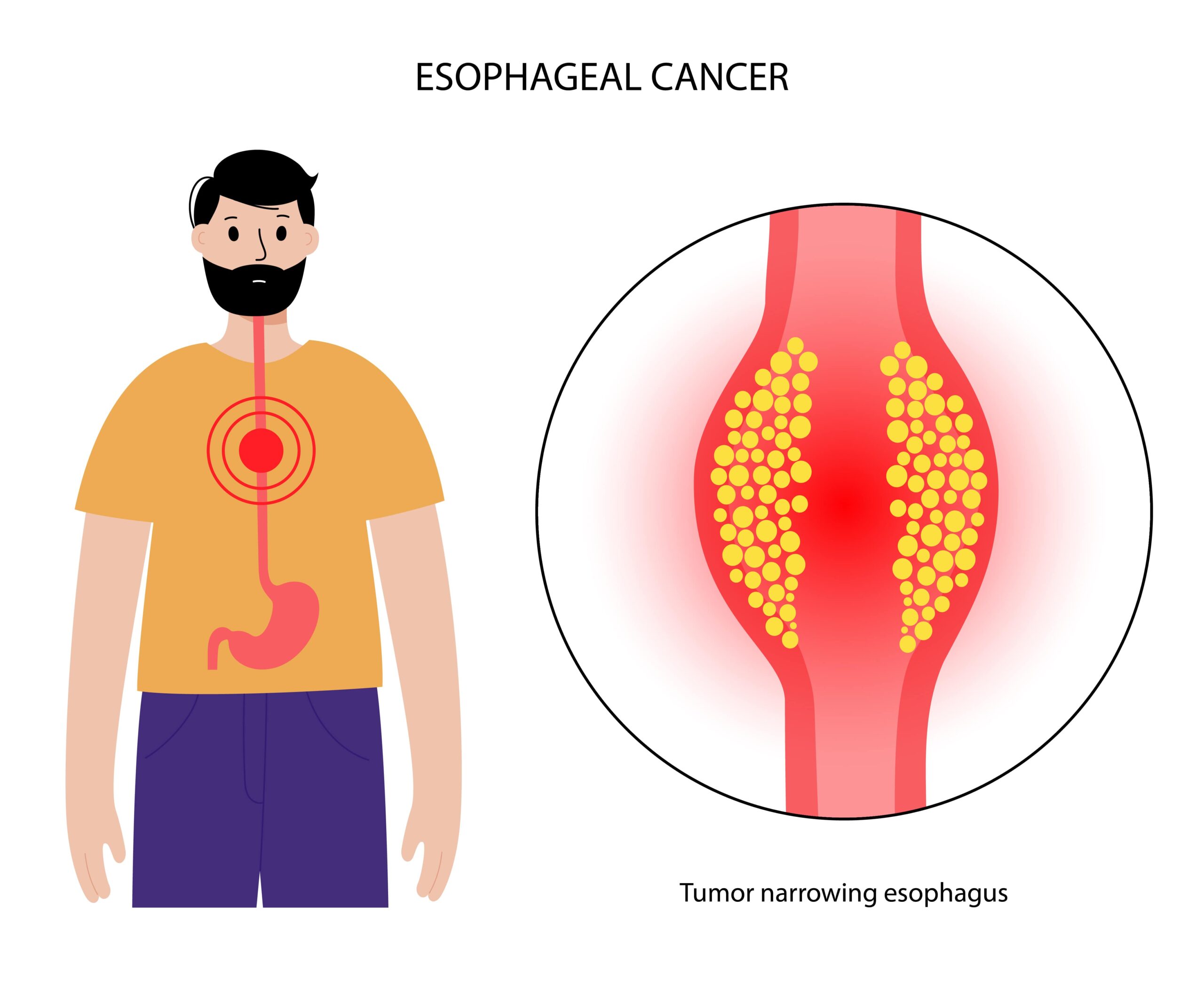 cancer-oesophage - Welliecare